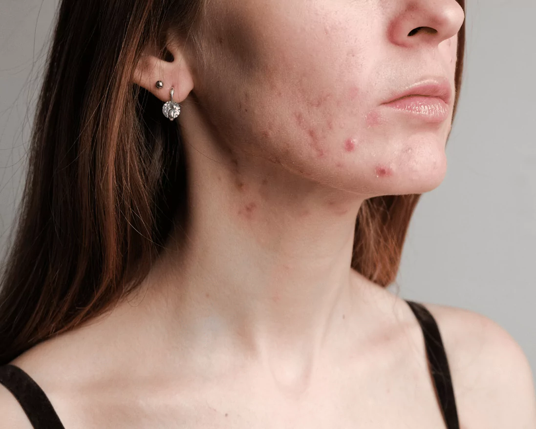 13 Skincare Mistakes To Avoid If You Have Acne Beauty Unbounded